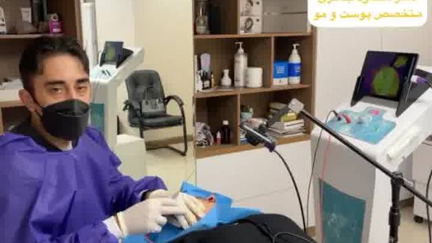 کاربرد دستگاه پزشکی Endo-RF Subcision - نمایش